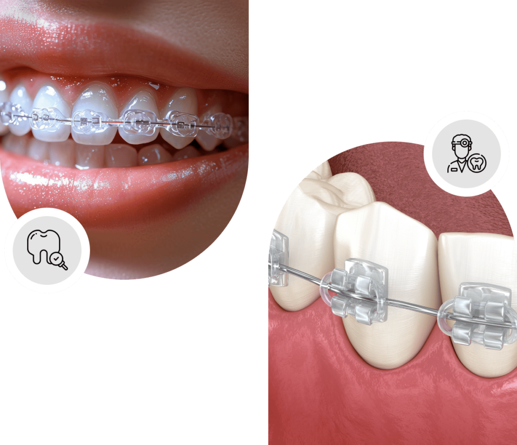 Invisible Clear Braces in Cambridge - Hespeler Road Dental